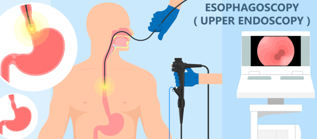 How are Patients Tested for Eosinophilic Esophagitis? – EoE Restore ...
